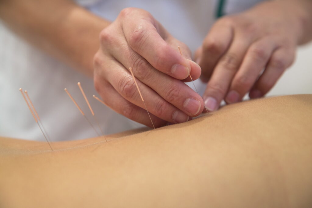 Acupuncture Treatment is Basic of Performing Asian Medicine ...